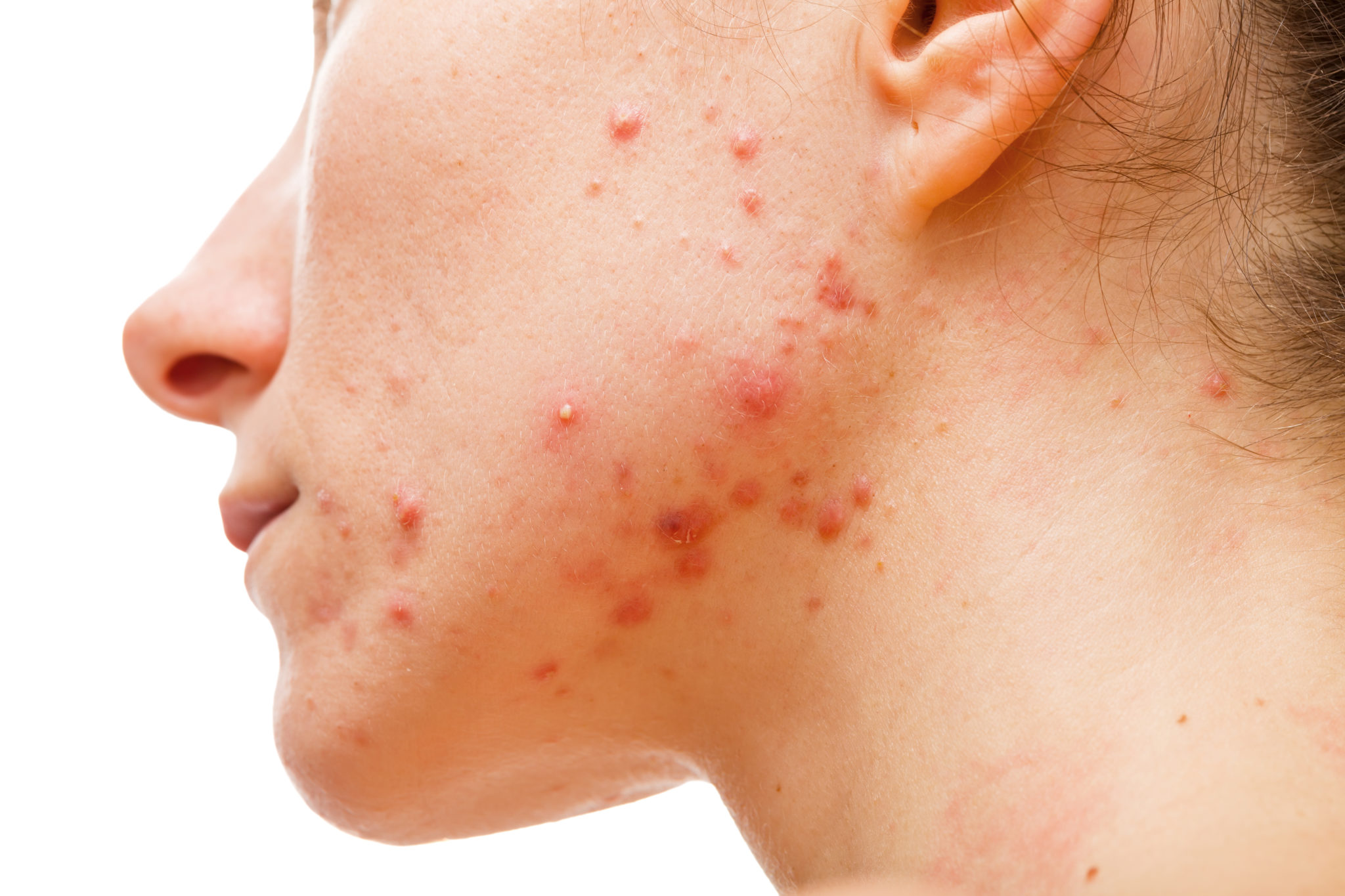 Identifying Different Types of Acne