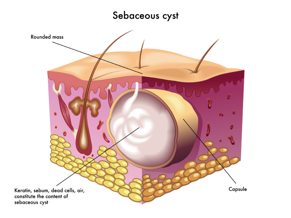 What Are Cysts And How To Treat Them 